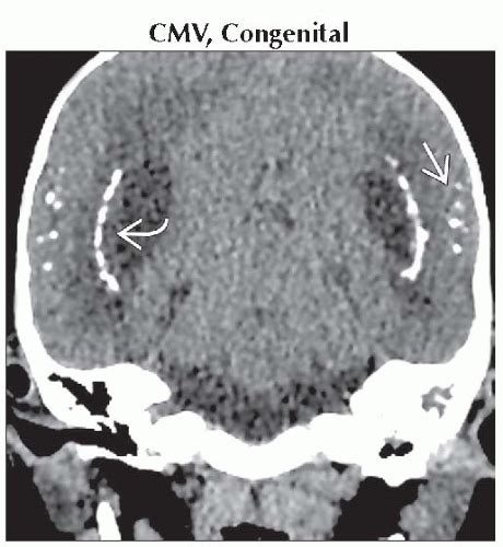 Periventricular Calcification Neupsy Key