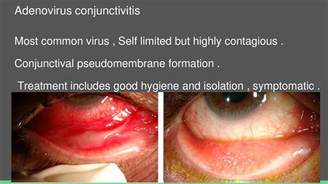 Viral Conjunctivitis Pseudomembrane Volume 4 Chapter 7 Follicular