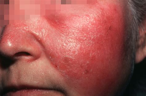 Erysipelas — Medlibes Online Medical Library