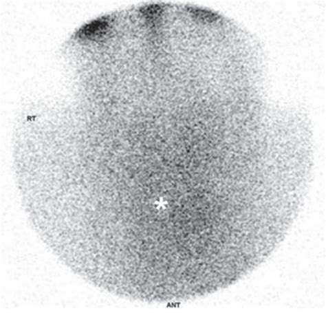 Thyroid Scan Shows Decreased Uptake Of Tc 99m Pertechnetate In The Download Scientific Diagram