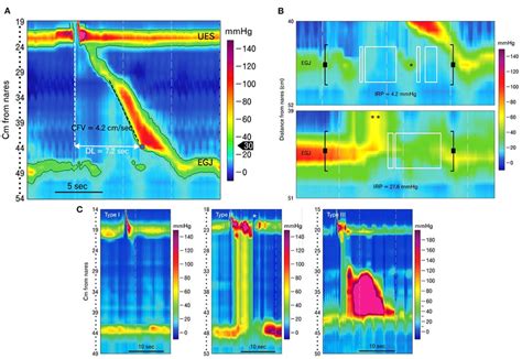 Endoluminal Functional Lumen Imaging Probe Endoflip A Image Of Download Scientific