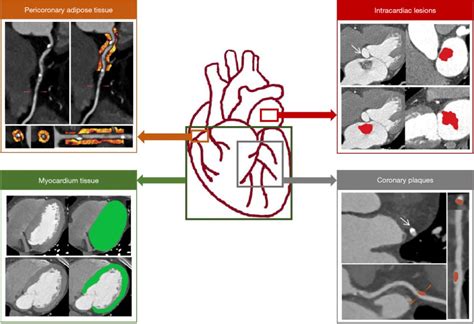 Cardiac Computed Tomography Radiomics A Narrative Review Of Current Status And Future