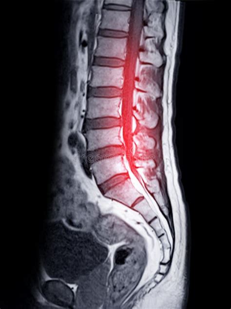 Mri L S Spine Or Lumbar Spine Sagittall T1w View For Diagnosis Spinal Cord Compression Stock