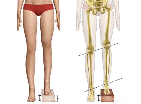 Leg Length Discrepancy Giotikas Clinic