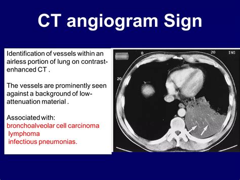 Radiological Signs In Chest Medicine Part 1 Pdf