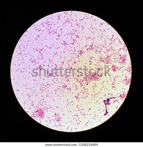 Microscopic View Gonorrhea Neisseria Gonorrhoeae Gramstained 스톡 사진