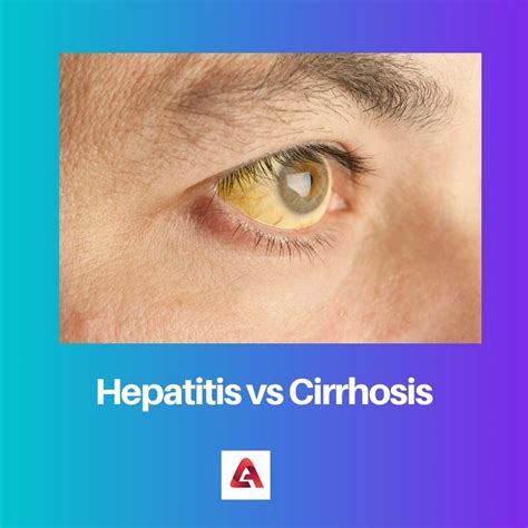 Hepatitis Vs Cirrhosis Difference And Comparison