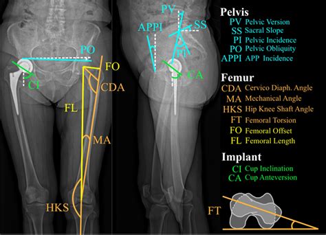 Pelvis And Femur Geometry Parameters Diaph Diaphyseal Download