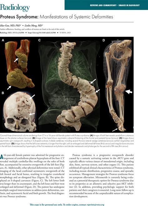Proteus Syndrome Manifestations Of Systemic Deformitiesradiology