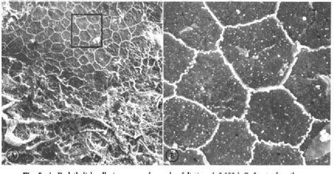 Figure 8 From Scanning Electron Microscopy Of The Trabecular Meshwork In Normal And Glucomatous
