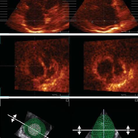Real Time Three Dimensional Echocardiography And Cardioc Magnetic