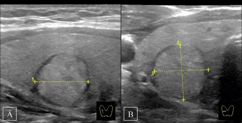 Benign Fnac Tn A Sagittal B Transversal The Nodule Was Not Download Scientific Diagram