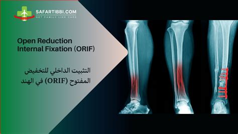 Open Reduction Internal Fixation