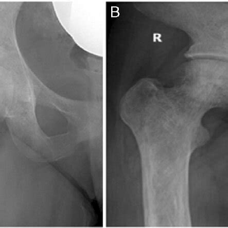 A AP View Of The Pelvis Demonstrating Patches Of Sclerosis With Coarse Download Scientific