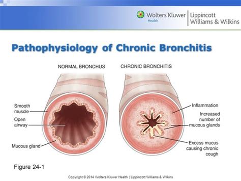Copd Bronchiectasis Cf Flashcards Quizlet