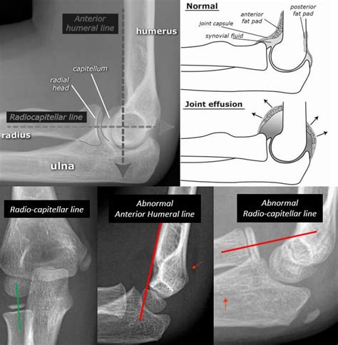Radiographic Anatomy Of Elbow At Martha Wilson Blog