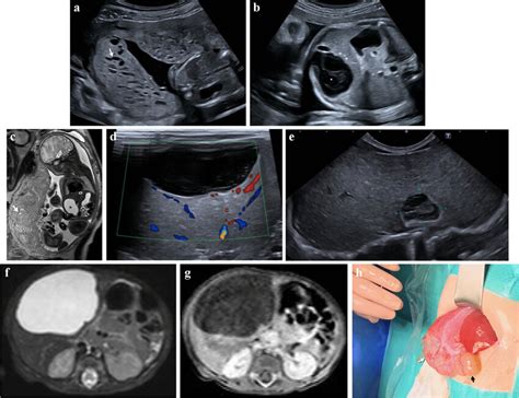 A Female Fetus With Hepatic Mesenchymal Hamartoma And Mesenchymal