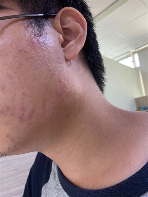 請益 誰可以救救我的爛臉 噁圖慎入 美妝板 Dcard