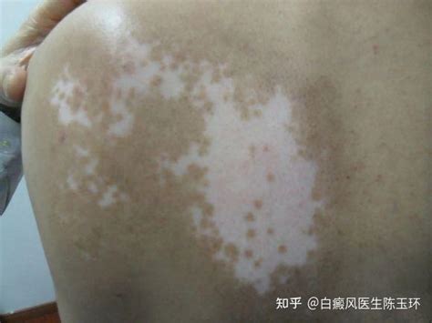 身上多处白癜风怎么治治好全身多处白斑花钱多吗 知乎