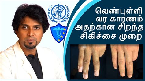வெண்புள்ளி நோய் என்றால் என்ன அறிகுறிகள் காரணங்கள் நோய் கண்டறிதல்