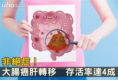 非絕症大腸癌肝轉移 存活率達4成 uho優活健康網