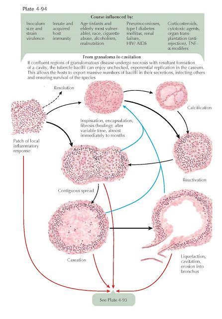 Tubercle Tuberculosis
