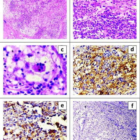Pictomicrographs Hande Show A Replacement Of Normal Lymph Nodal Download Scientific Diagram