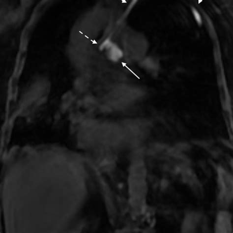 Lymphogram Of The Thoracic Duct With An Angiomatous Appearance Download Scientific Diagram