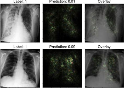 Predicting Ejection Fraction From Chest X Rays Using Computer Vision For Diagnosing Heart