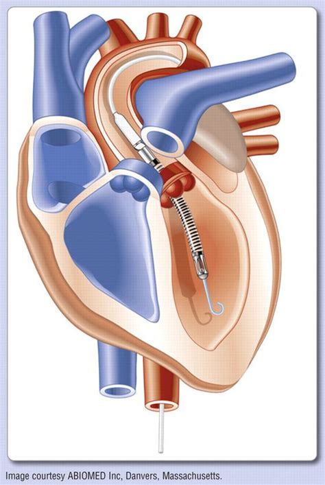 Impella 25 By Abiomed The World Smallest Heart Pump Ventricular