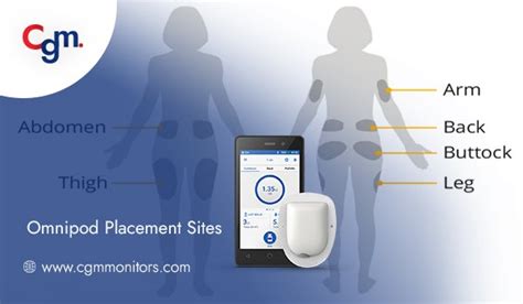 Omnipod Dash Vs Omnipod 5 Detailed Comparison 2024