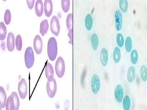 Practical Hematology Lab Lab 3 Reticulocyte Count Reticulocyte