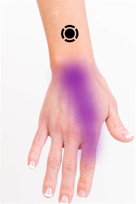 Extensor Indicis Summary Komizo Diagnostics