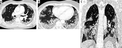 COVID High Resolution Computed Tomography Findings In The First Patients Admitted To The