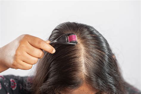 여성의 탈모 치료를 위한 마이크로니들링 요법 클로즈업 샷 머리가 빠지다에 대한 스톡 사진 및 기타 이미지 머리가 빠지다 여자 여성 Istock