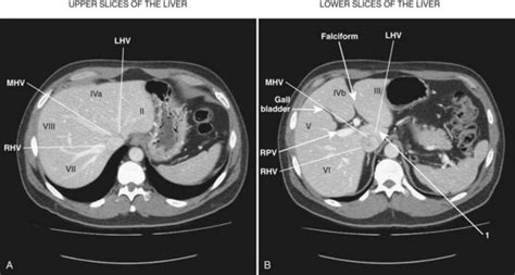 Segment Oriented Anatomic Liver Resections Abdominal Key