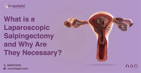 Discover The Significance Of Laparoscopic Salpingectomy