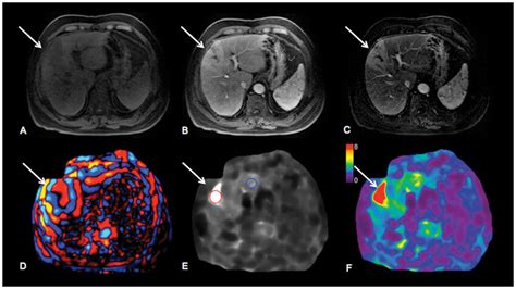 67 Year Old Male Patient With Hcv Cirrhosis And Untreated Infiltrative