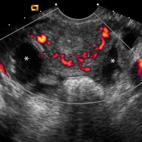 Endometrial Polyp Longitudinal Image From A Transvaginal Download Scientific Diagram