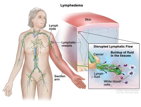 Severe Lymphedema Arm