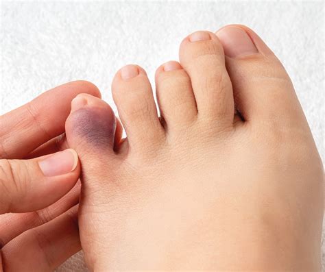 Understanding Foot Bruising Carrollton Foot Center