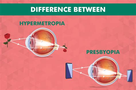 Recommended Difference Between Presbyopia And Hypermetropia Planet Lasik