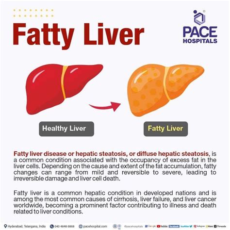 Fatty Liver Disease Symptoms Causes Risks And Treatment 60 Off