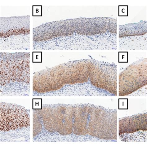 Immunohistochemical Expression Of Ki 67 A Cin1 D Cin2 G