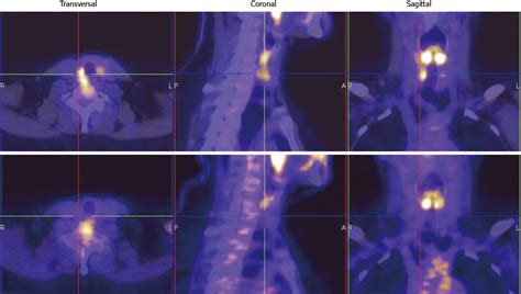 Malignant Tumor Of Parathyroid Gland Semantic Scholar