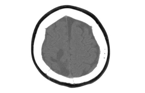Cranial Loop Flap Fixation Angelmed Asia