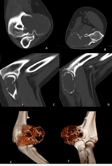 Ct Scans Of The Right Elbow With 3d Reconstruction A Coronal Section