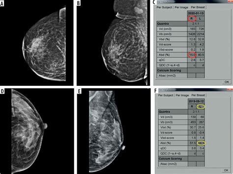 Association Of Mammographic Breast Density Measurements And Hormone Receptor Status Of Breast Cancer