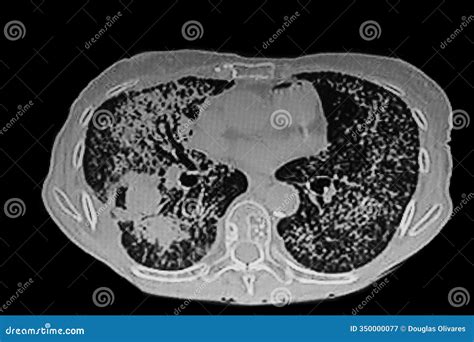 Chest Ct Scan Of Lung Cancer Adenocarcinoma With Miliary Pattern Stock Illustration