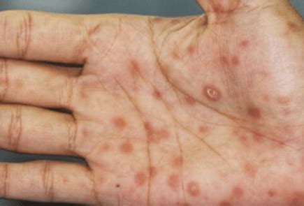 Sexual Transmitted Disease STD A Klinik Penang